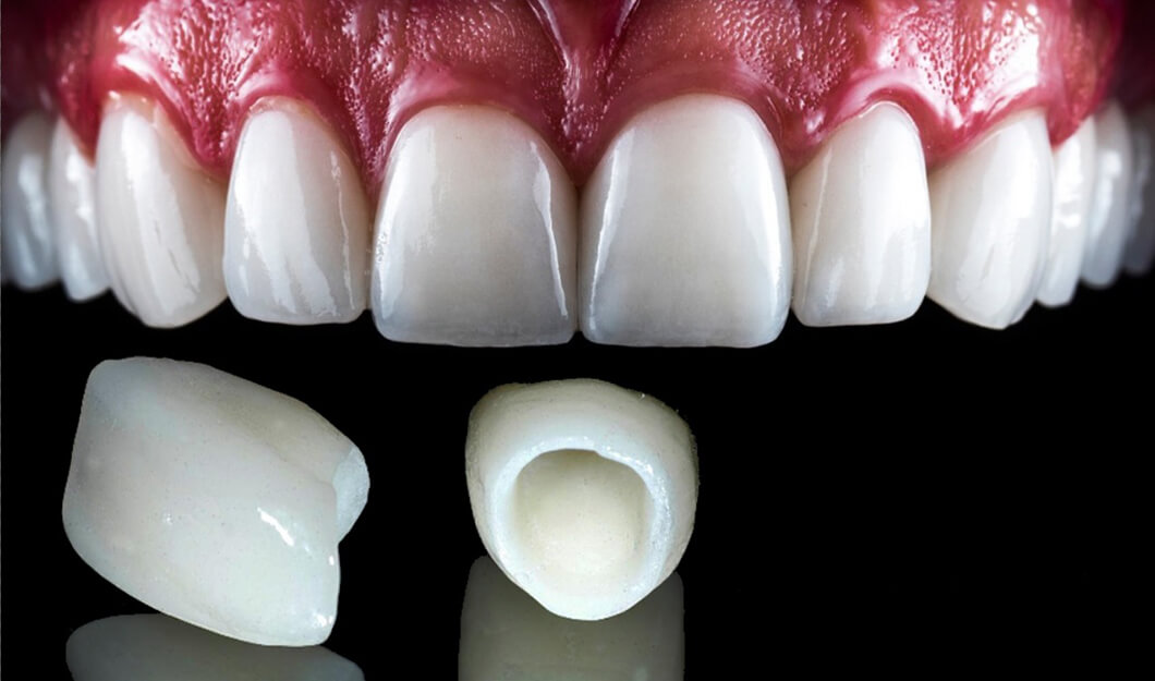 Emax Veneer WestModern Clinic Emax Veneer WestModern Clinic