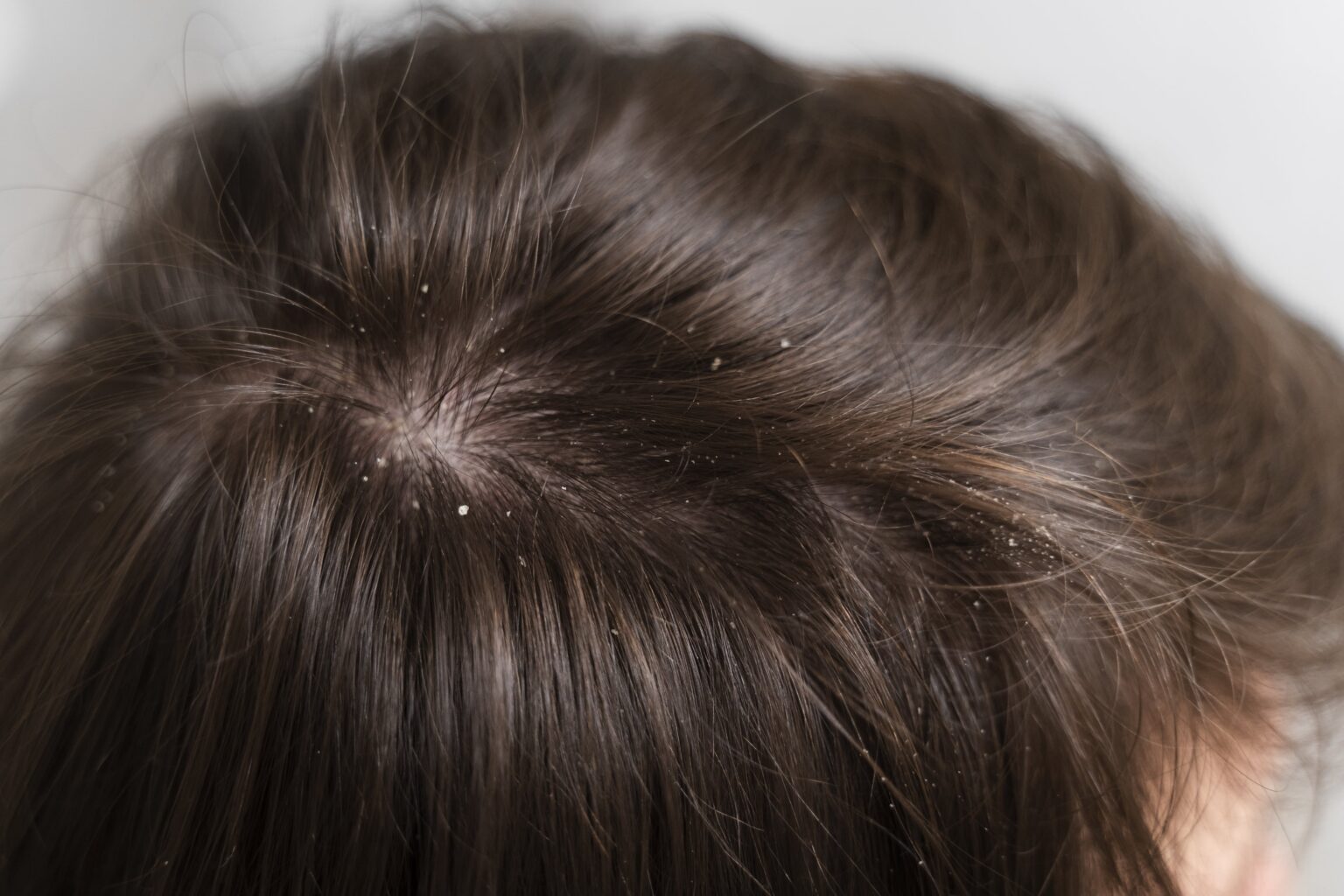 What Are PCOS Hair Growth and PCOS Hair Loss? – WestModern Clinic