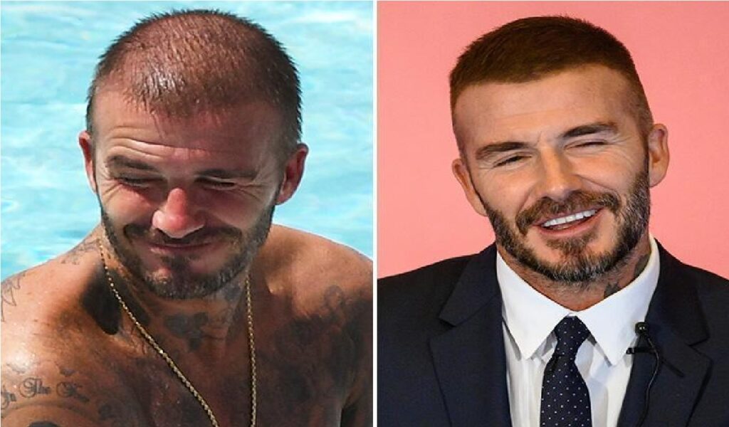 David Beckham Hair Transplant