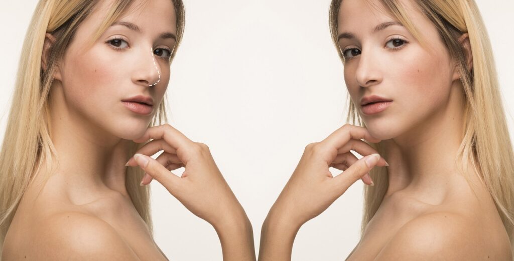 Septoplasty Before and After Process