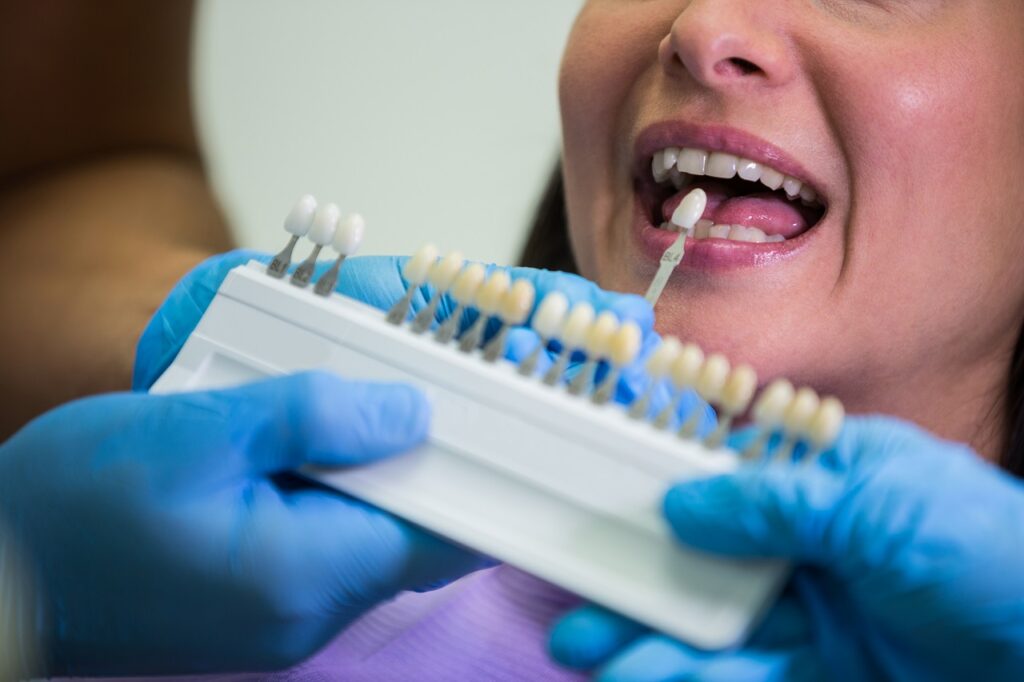 What is Emax Dental Veneers?