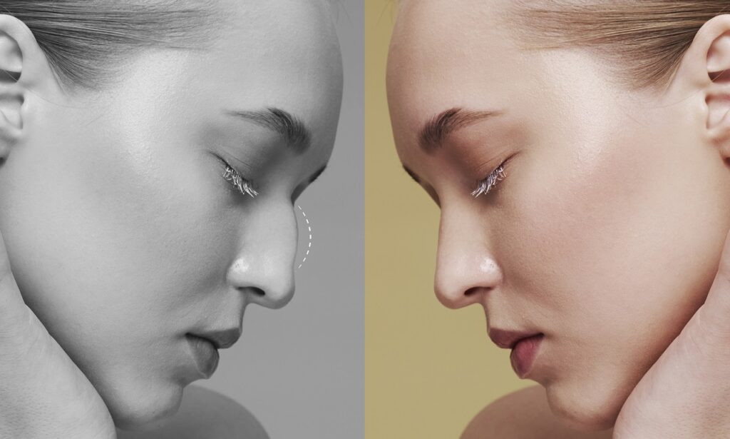 What is Nose Type Chart? What Does It Mean?