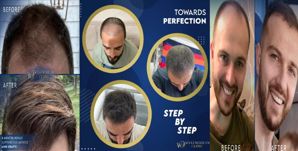 Hair Transplant Turkey: Affordable and High-Quality