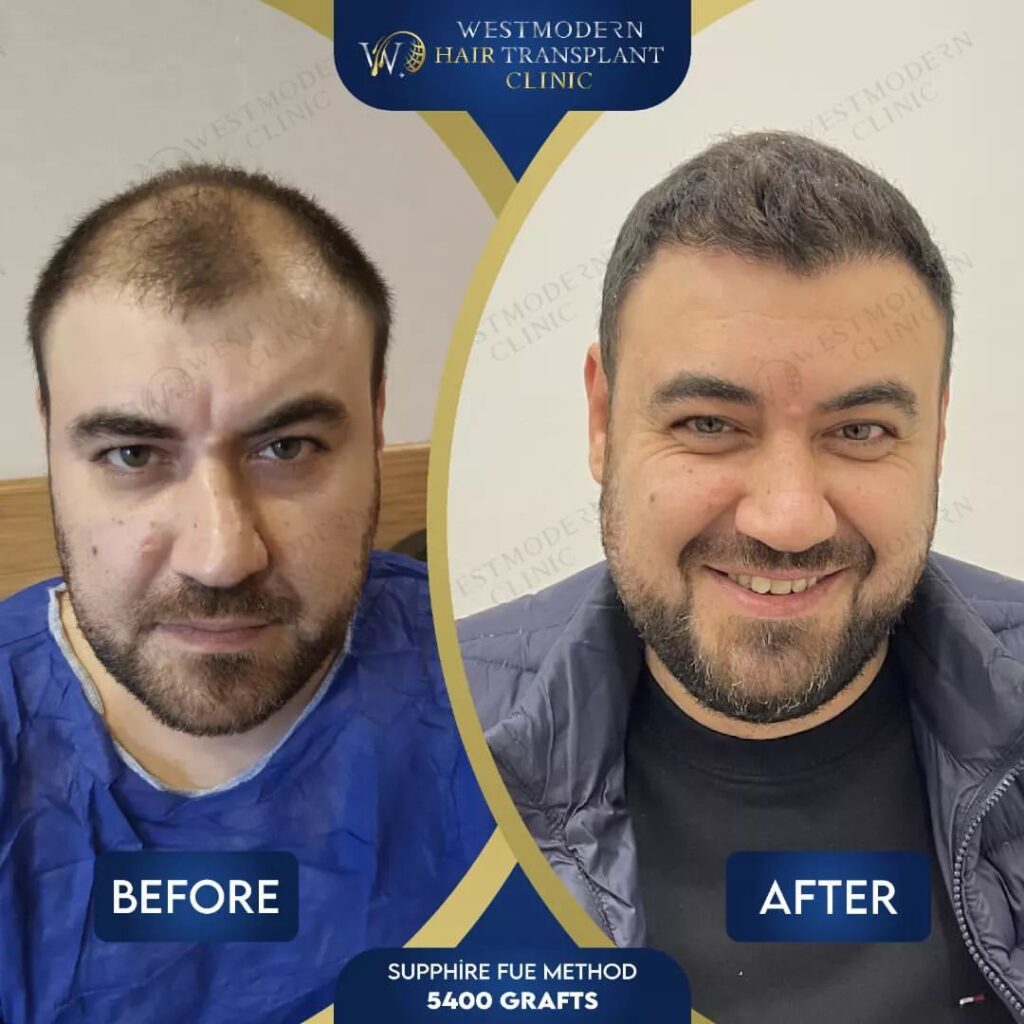 Hair Transplant Turkey Before And After What You Need To Know